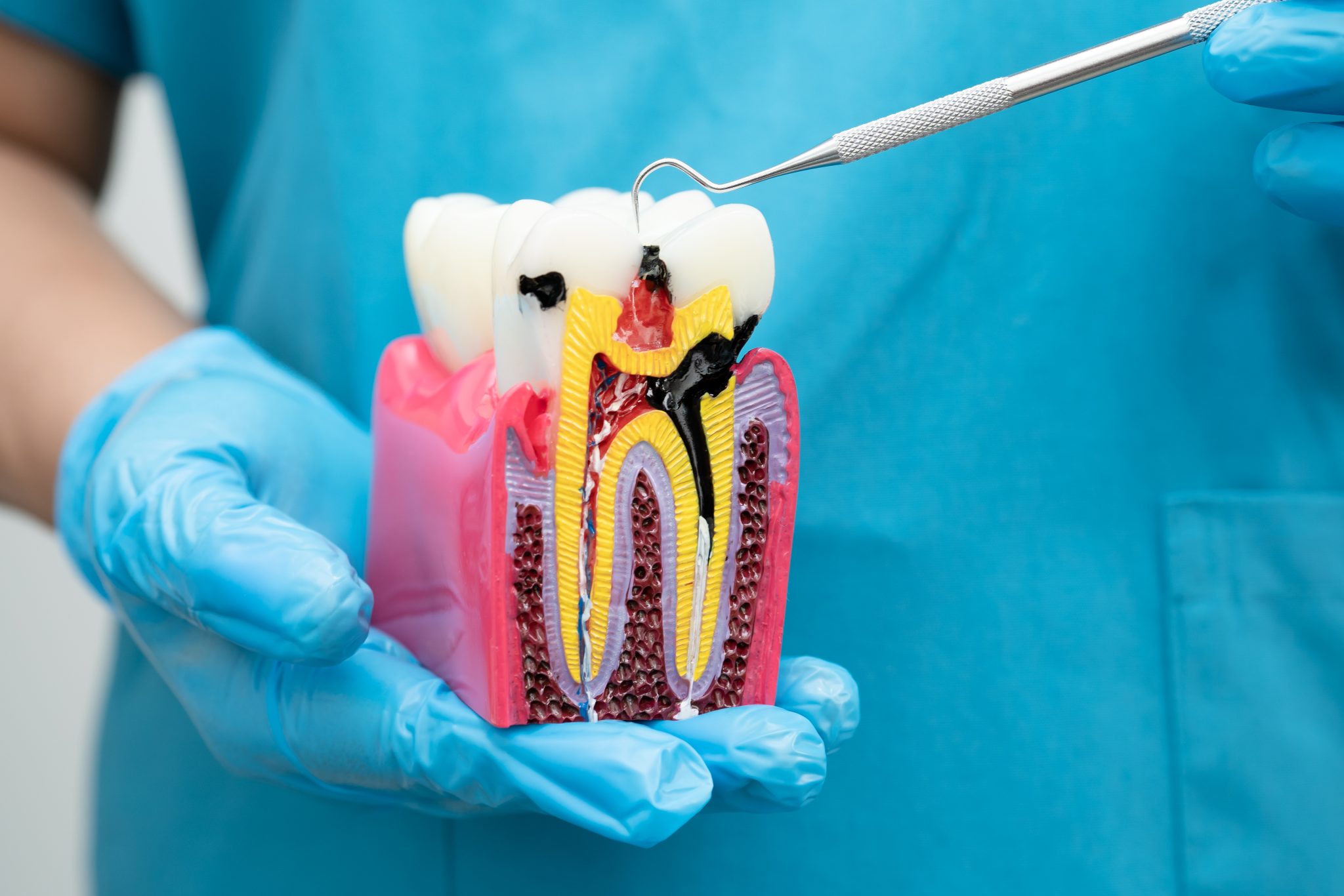 Root Canal Before and After | What to Expect & Results